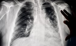 Black lung disease is still killing coal miners, and the coal industry ...